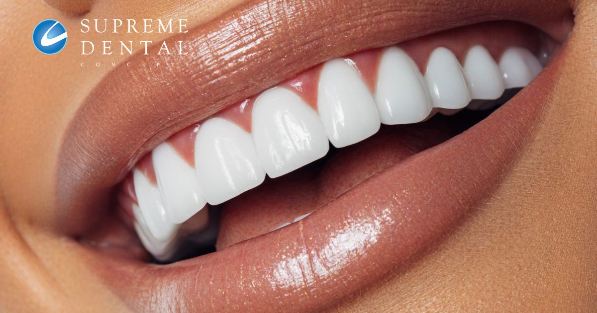 Understanding White Fillings | Composition & Benefits | Supreme Dental ...